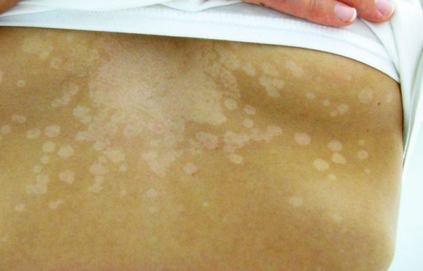 Bệnh Lang Ben: Nguyên Nhân, Dấu Hiệu Nhận Biết Và Điều Trị