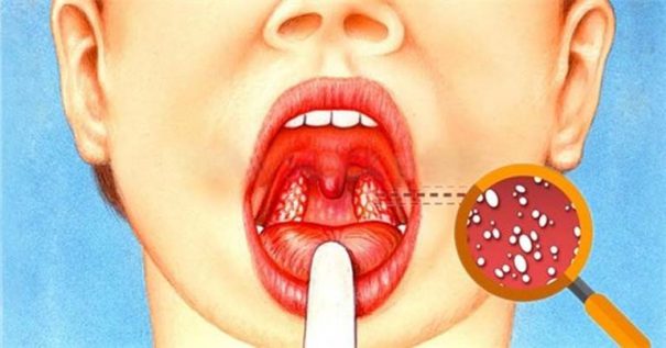 Viêm Amidan Hốc Mủ Bã Đậu Là Gì, Có Nguy Hiểm?
