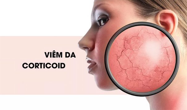 Da Nhiễm Corticoid Là Bị Gì? Dấu Hiệu Nhận Biết Và Điều Trị Thế Nào?